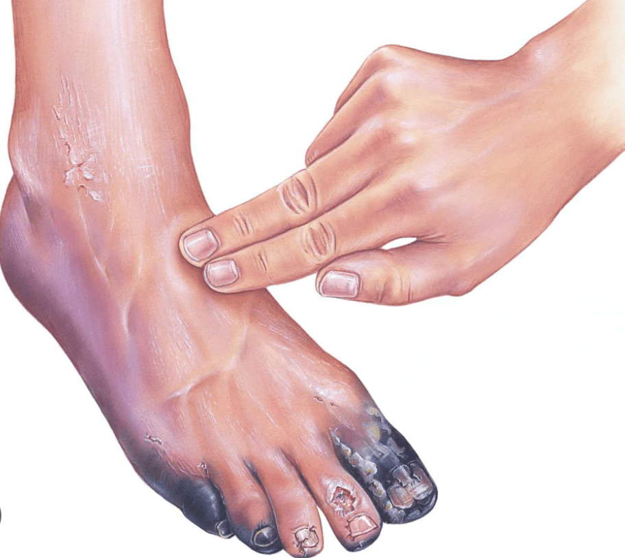Gangrene in Diabetic Feet: Causes, Symptoms, and Treatment