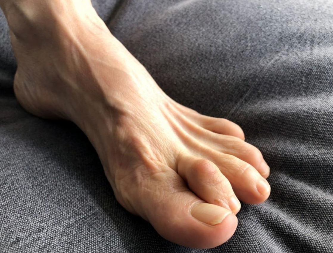 Hammertoe Relief: Surgical and Non-Surgical Treatment Options